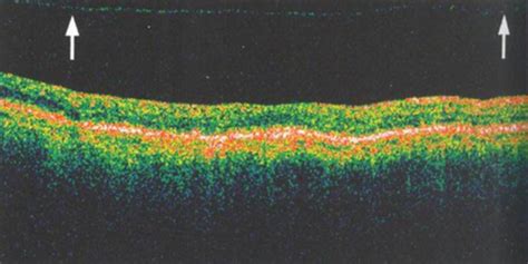 Retina Exam 3 Retinal Breaks And Retinal Detachments Flashcards Quizlet