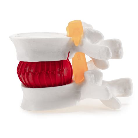 Buy Winyousk Human Intervertebral Disc Herniation Model Eeducational Display Tool Anatomical