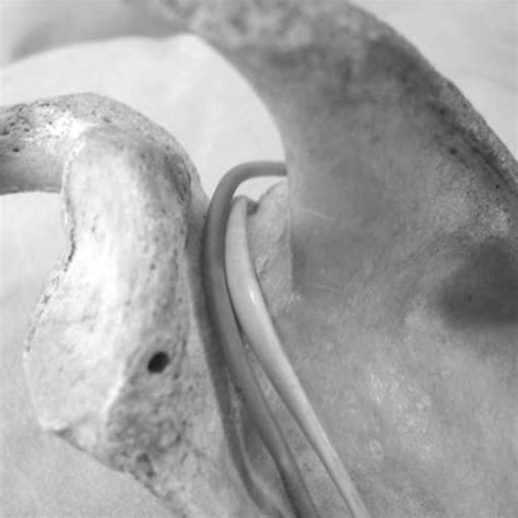 Pdf Suprascapular Nerve Block Important Procedure In Clinical Practice