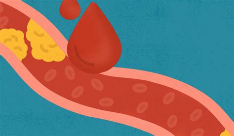 The Impact Of High Cholesterol On Men The News God