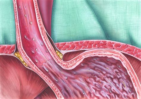 An Overview Of Gastrointestinal Dysfunction In Systemic Sclerosis