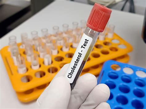 สตรคานวณ LDL HDL สดสวนไขมนเลวและด คำนวณเองเพยง 1 นาท