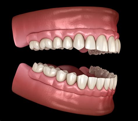 Total Denture Orthodental