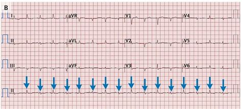 Electrical Alternans