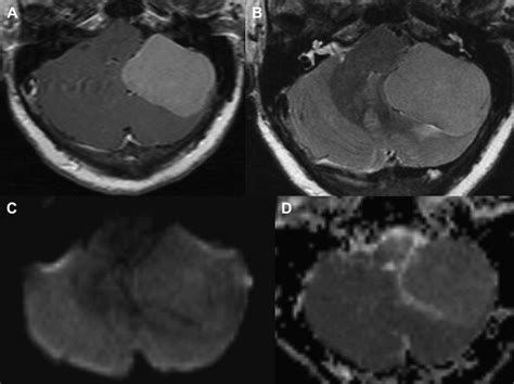 Diffusion Mr Imaging An Important Tool In The Assessment Of Brain