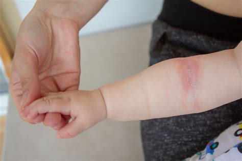 Prickly Heat Causes Symptoms Treatment And Prevention