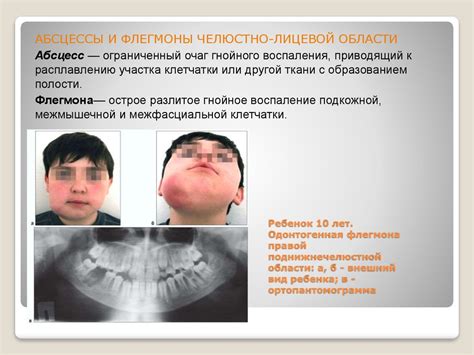 Воспалительные процессы челюстно лицевой области презентация онлайн
