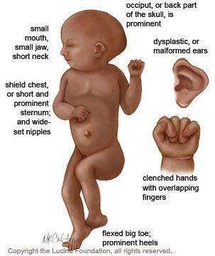 Trisomy Syndrome Edwards Syndrome