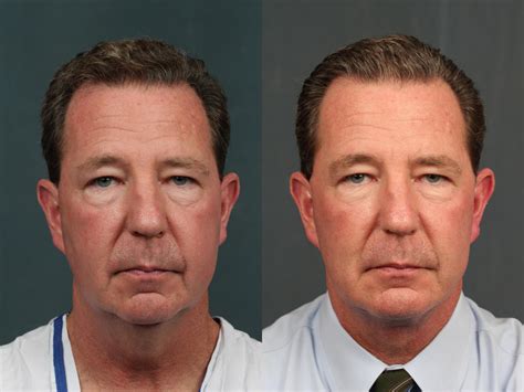 Chin Augmentation Before And After Photos Patient 730 Louisville Ky