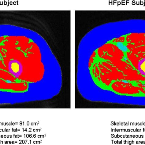 Relationship Between Intermuscular Fatskeletal Muscle Ratio And Peak