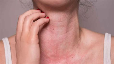 Can Hay Fever Cause Hives Nowpatient