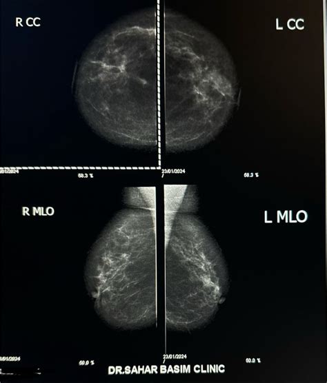 Wire Localization Of Small Mass At Pre Operative Procedure Of Rt Breast Sahar Ahmed Fareed