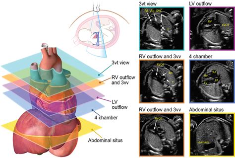 Axial Planes Suggested For Screening The Fetal Heart At The Time Of The Download Scientific
