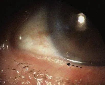 Dry Eye Treatment Gold Coast Dr Nick Andrew Ophthalmologist