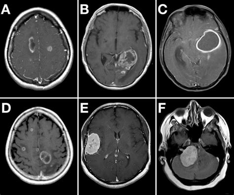 Brain Mri Scan Tumor