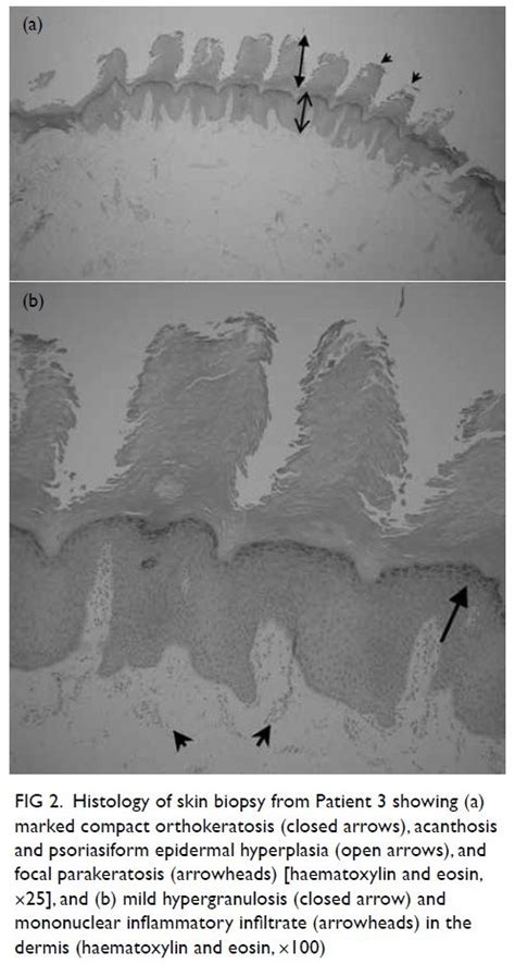 Isolated Hereditary Diffuse Palmoplantar Keratoderma In Hong Kong Chinese Patients A Case