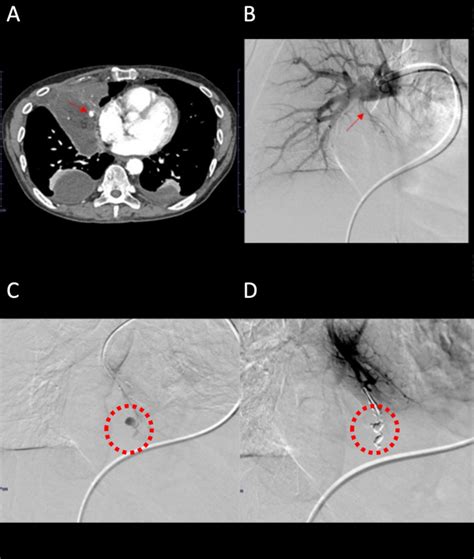 A Hidden Danger Lung Abscess Following Inhalation Of Kerosene Based Pyrethroid Insecticide