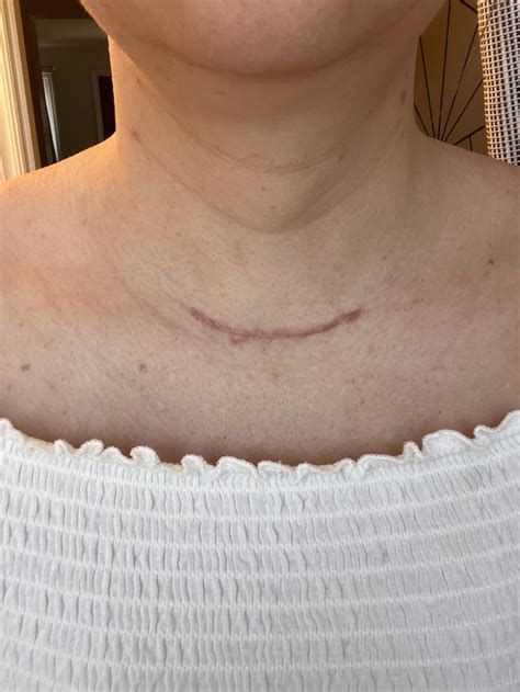 2 Months Post Total Thyroidectomy R Gravesdisease