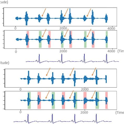 Schematic Diagram Of The Segmentation Of The Heart Sound From A Patient Download Scientific