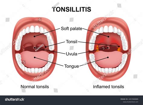 Tonsillitis Throat Infection Inflamed Tonsil Illustration Stock