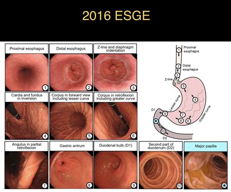 Upper Endoscopy And Prep — Gastroenterology East P A