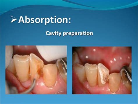 Laser Dental Hard Tissue Interaction With Possible Applications 2 Ppt