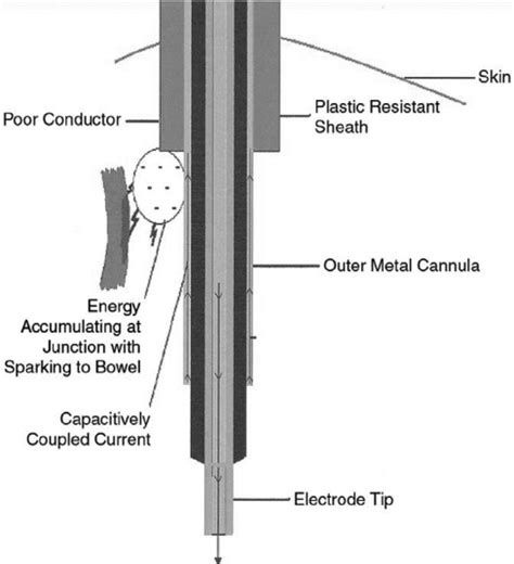 Capacitive Coupling A Capacitively Coupled Current Typically Returns