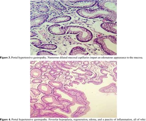 Figure 1 From Comparison Of Portal Hypertensive Gastropathy And Gastric
