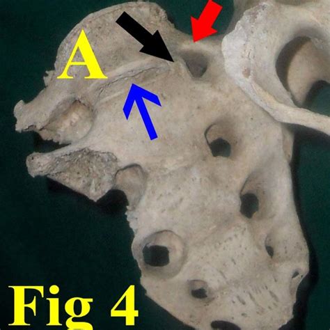 Showing Bilateral Sacralization A 5 Th Lumbar Vertebra Red Colour Download Scientific Diagram
