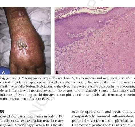 Case 2 Mitomycin Extravasation Reaction A Indurated Erythematous