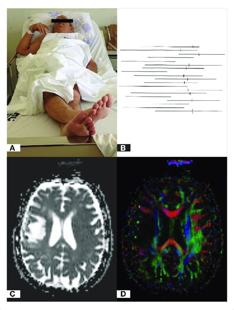Crossed Leg Sign In A Patient With Unilateral Spatial Neglect A