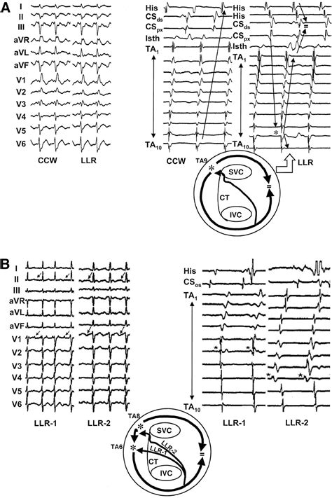 Surface Electrocardiographic Characteristics Of Right And Left Atrial