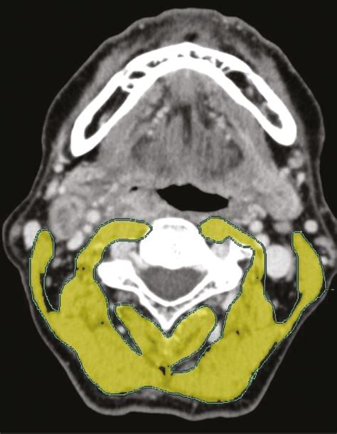 Figure 1 From Impact Of Relative Cisplatin Dose To Skeletal Muscle Mass On Adverse Events In