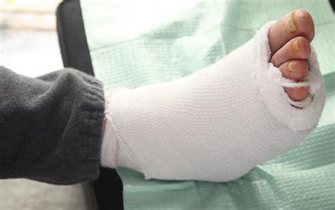 How Do I Treat A Fractured Pinky Toe With Pictures