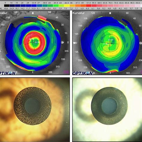 Pdf Reading Performance After Implantation Of A Modified Corneal Inlay Design For The Surgical