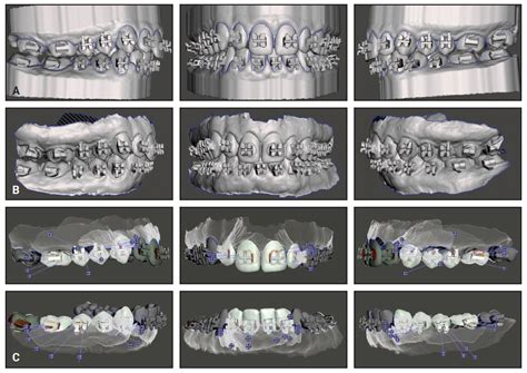Efficacy Of Lightforce Custom Brackets