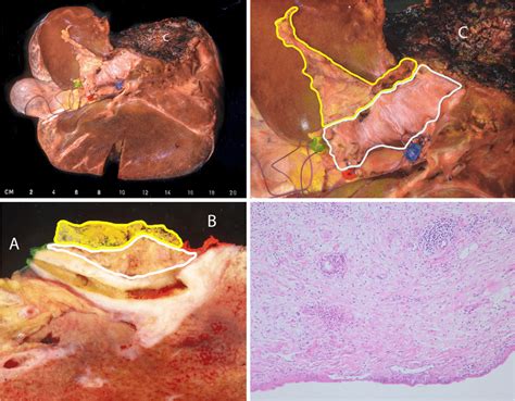 1 Overview Of Surgical Specimen In Extended Right Hemihepatectomy Download Scientific Diagram