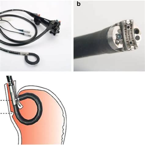 Appearance Of The Esophagogastric Junction On Direct View Left And