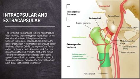 Proximal Femur Fracture Classification Ppt Ppt