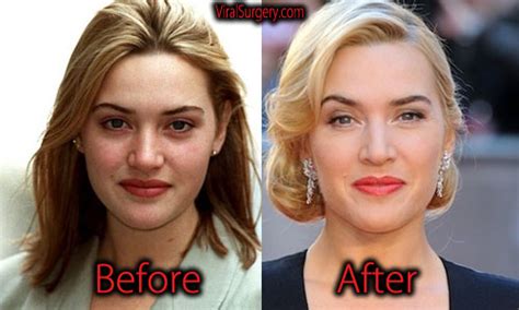 Kate Winslet Plastic Surgery Before And After Nose Job Botox Pictures