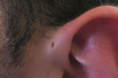 40 Facts About Preauricular Sinus And Cyst