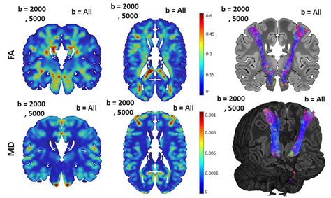 The Douglas Bell Canada Brain Bank Post Mortem Brain Imaging Protocol Published In Aperture Neuro