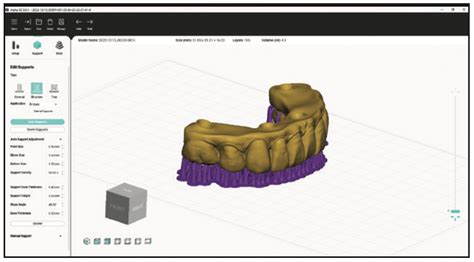 A Simplified Completely Digital Workflow For Full Arch Temporary Restorations Dentistry Today