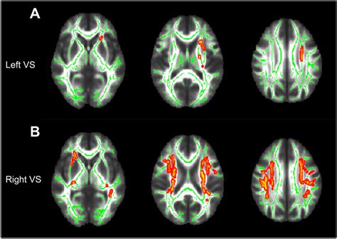 Axial Diffusivity Map Showing Significantly Higher Fractional