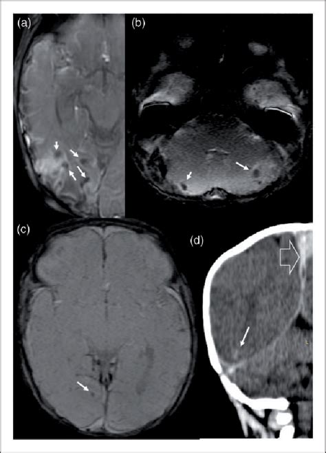 A Case 1 Gradient Echo T2 Susceptibility Weighted Angiography Swan Download Scientific