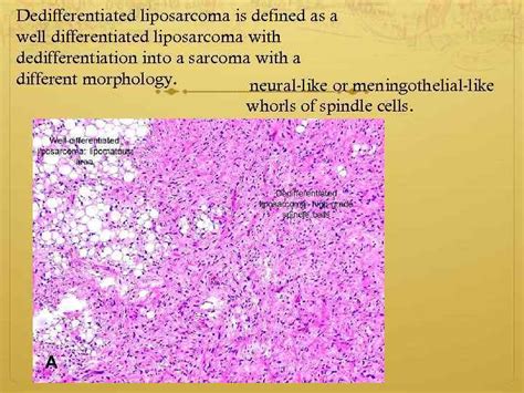 Department Of Pathological Anatomy Liposarcoma Prepared By Imangali