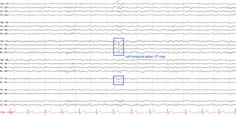 Epileptiform Abnormalities In Eeg Genspark