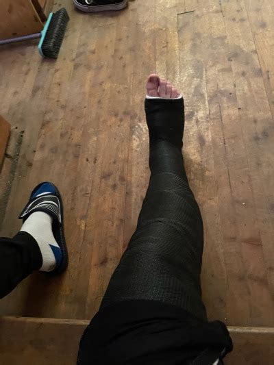 Leg Cast On Tumblr
