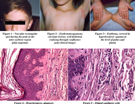 Erythrokeratodermia Variabilis
