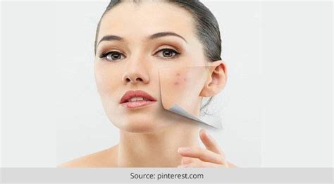 Top 3 Acne Treatment Masks That Claim To Give You Clear Skin